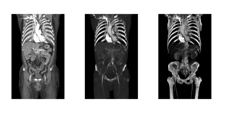 Full-Body MRI Screening - Istanbul Health Check Up Center