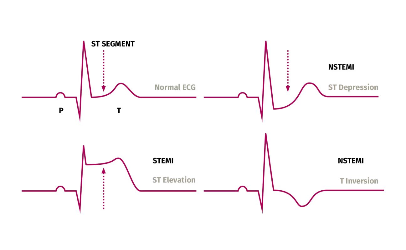 ECG or EKG - Istanbul Health Check Up Center